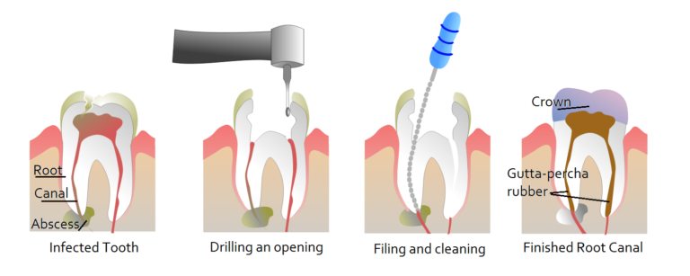 Root Canals in South Fort Worth & Arlington | Abram Dental
